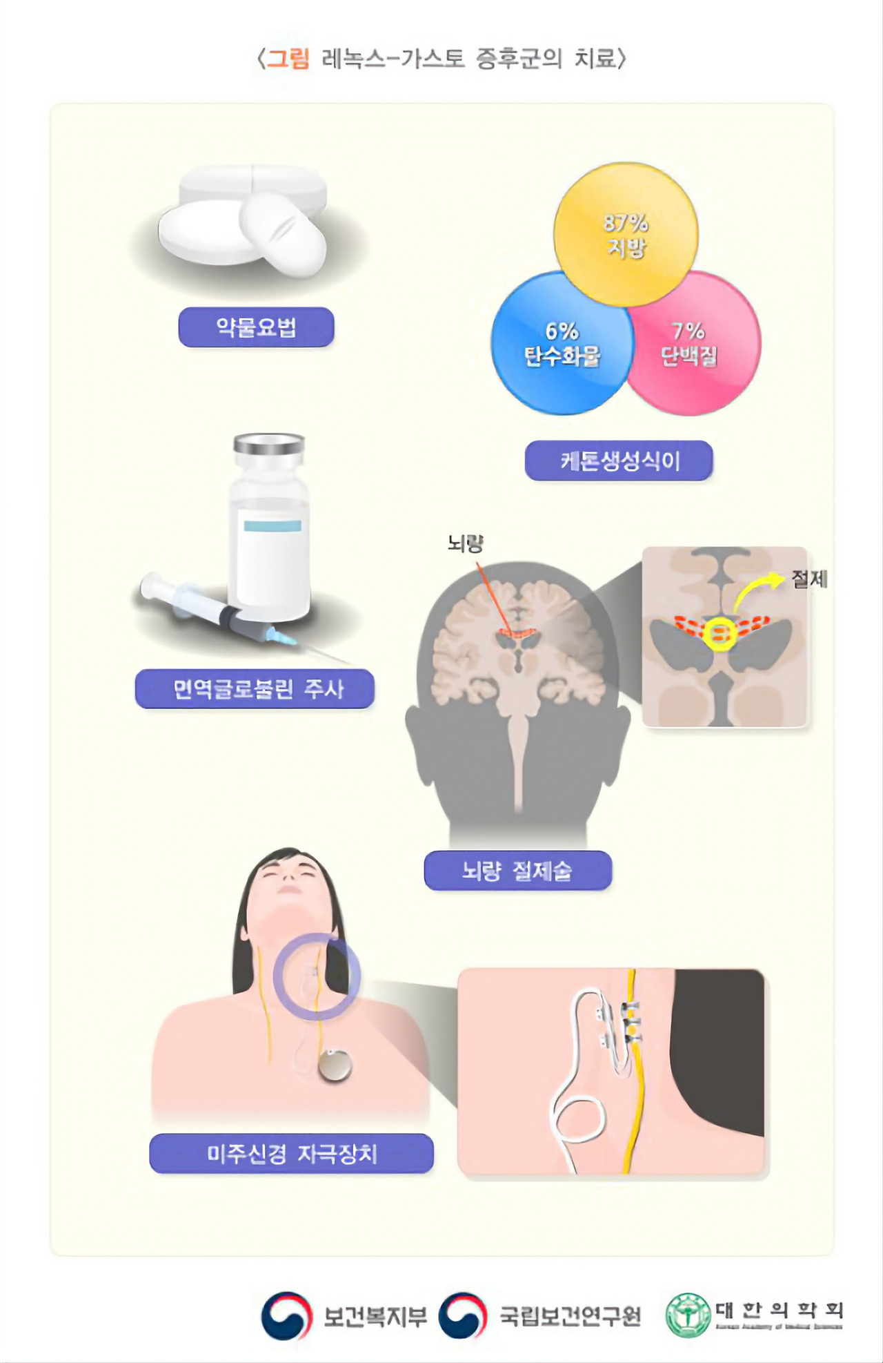 소아 간질소아 뇌전증소아 간질 증상소아 뇌전증 완치율소아 뇌전증 증상소아 뇌전증 치료제소아 뇌전증 식이요법