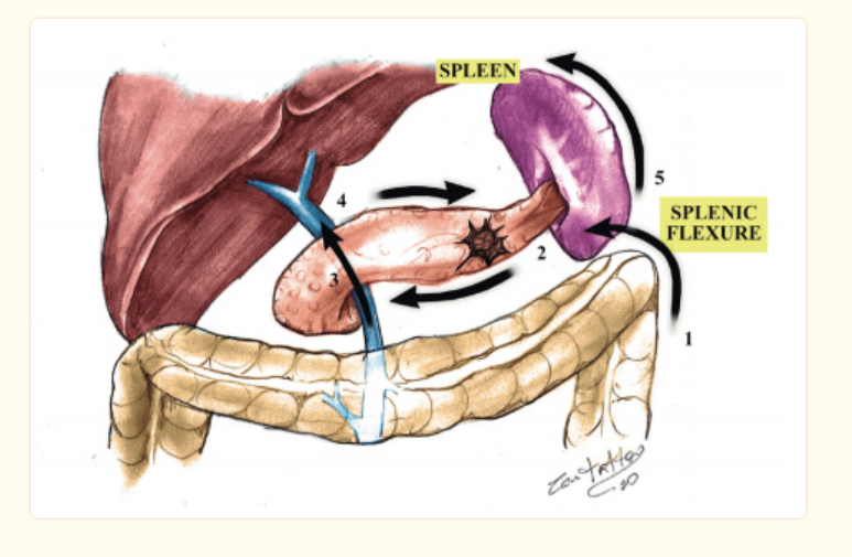 원위부 췌장 절제술과 비장적출술이란? (Distal Pancreatectomy and Splenectomy)