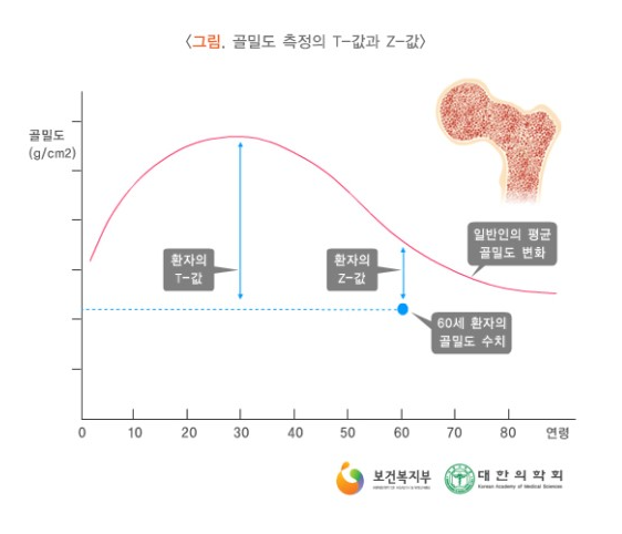 골다공증수치bmd 보는법 골밀도수치 진단기준