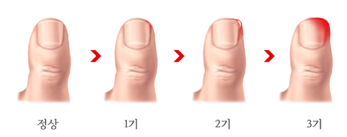 엄지발가락 내성발톱 증상과 자가치료