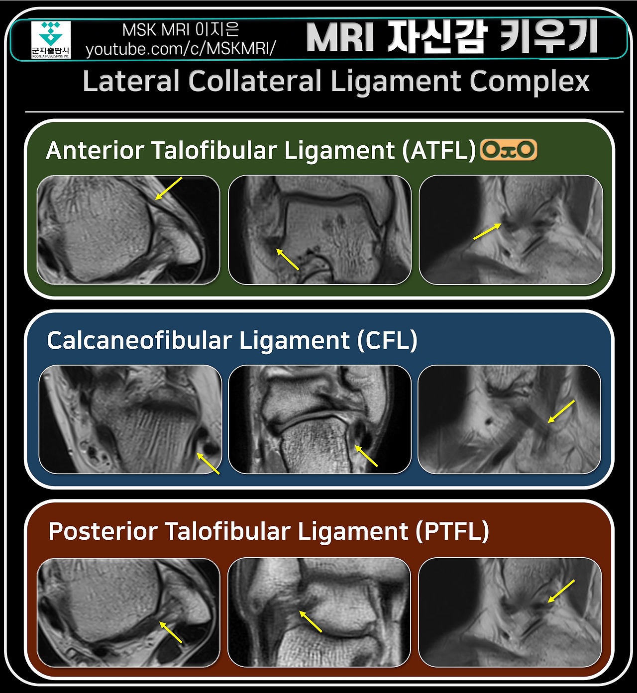 [MRI 자신감키우기-01] Lateral collateral ligament, , 군자출판사, ATFL, CFL ...