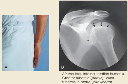 일반촬영 x-ray 엑스레이 어깨(shoulder series) - shoulder AP 촬영방법