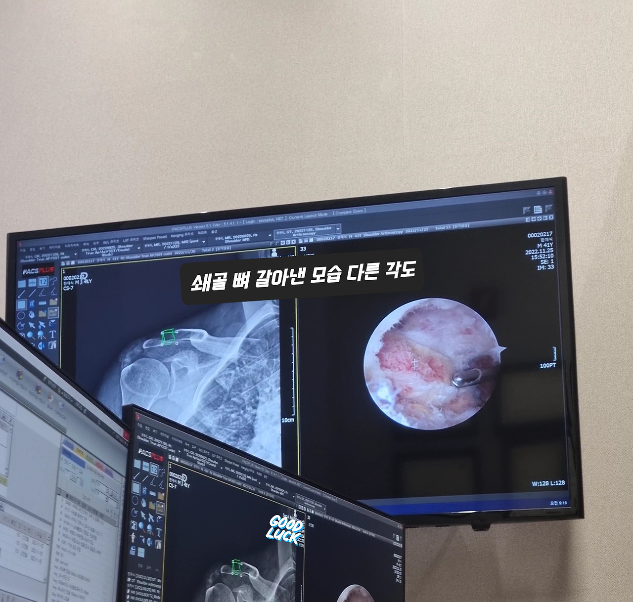 어깨수술 후 MRI 검사 결과 보기 :: 모두의 생활정보