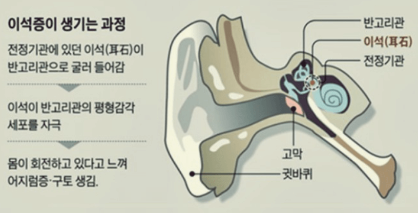 이석증 증상 원인 치료 운동법