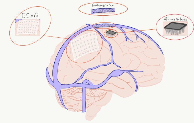BCI(Brain-computer interface)란? 뇌 컴퓨터 인터페이스 정의 활용사례