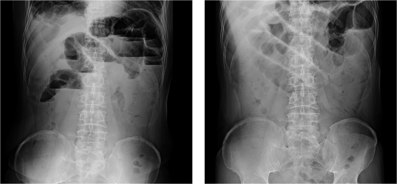 기계적 장폐색증 (Mechanical ileus) #케이스