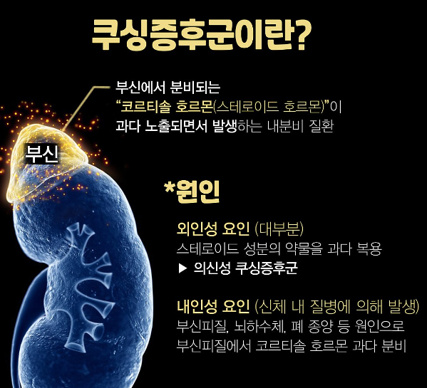 가수 이은하 쿠싱증후군 증상, 원인, 치료 방법