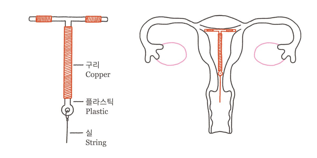 자궁내 피임장치iud 호르몬비호르몬 장치의 장단점 및 주의사항 궁금하닥questiondoc