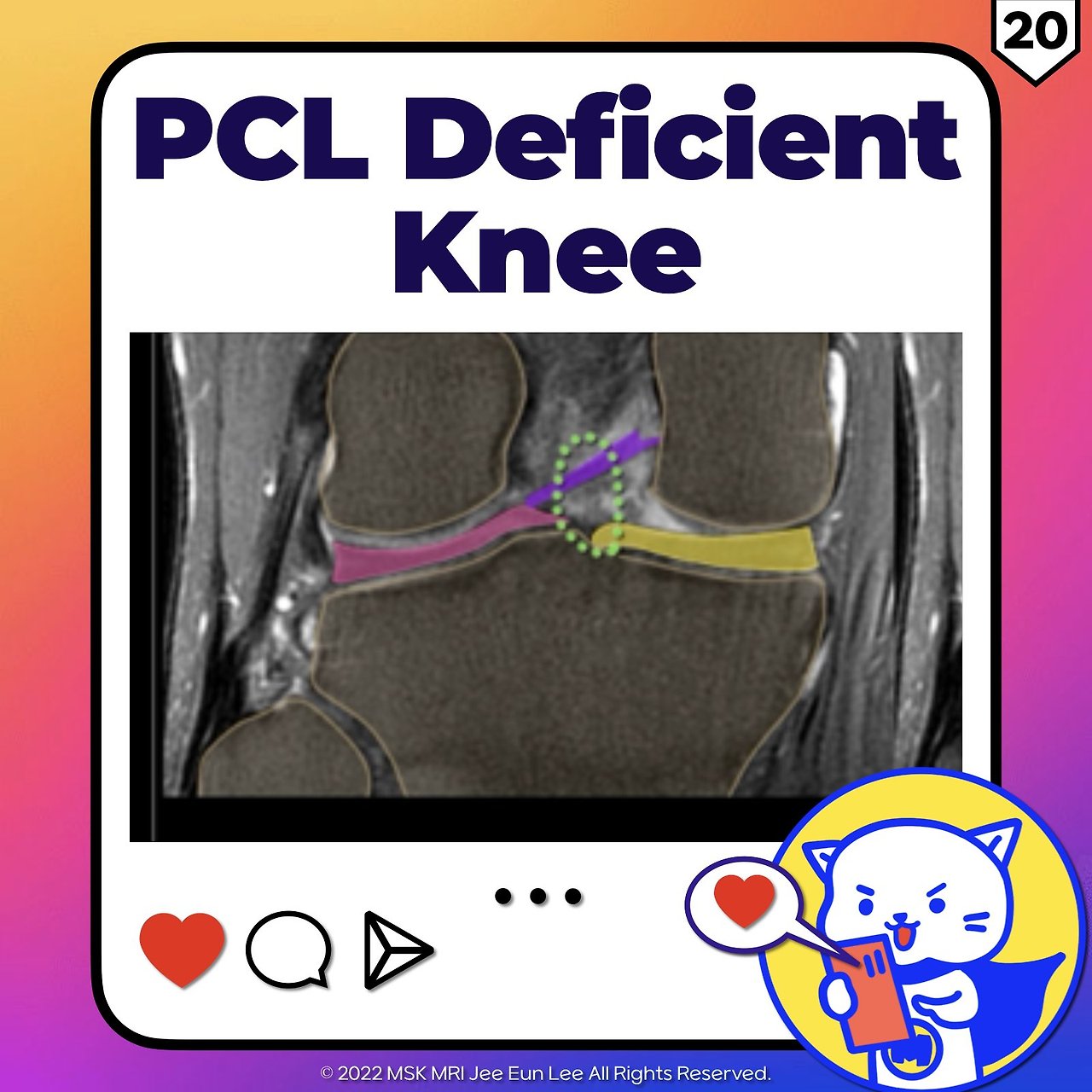 (Fig 2-E.20) PCL Deficient Knee with Delayed Imaging