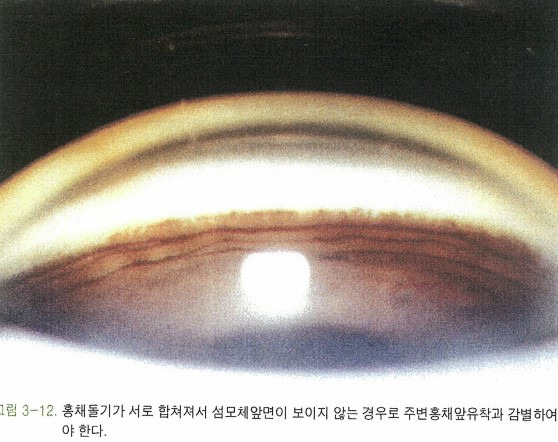 전방각의 구조 전방각경 소견 홍채뿌리 섬모체띠 홍채돌기