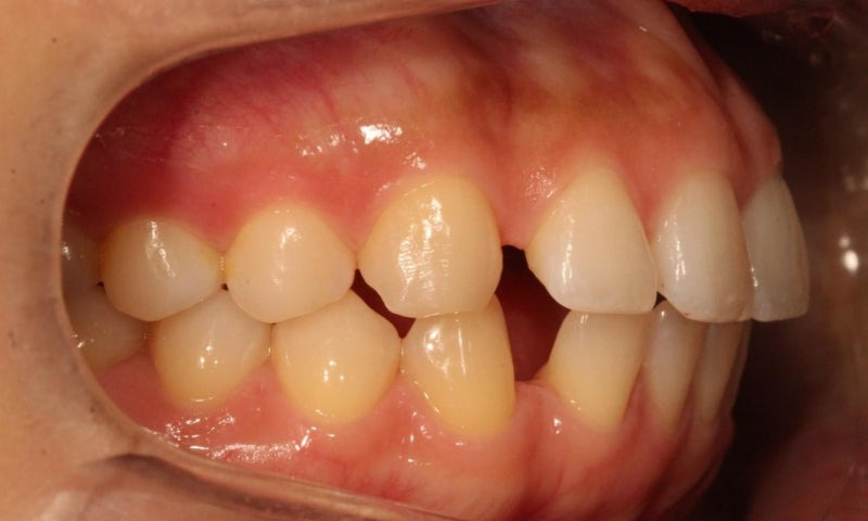 [Korea Dental treatment] Front teeth spacing can have different causes ...