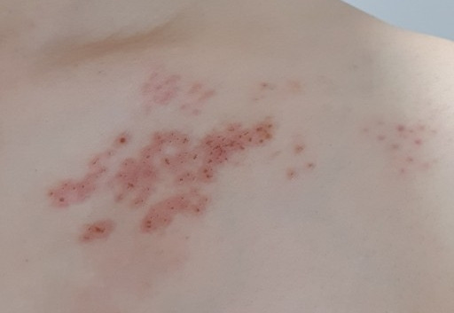 대상포진 과 입술포진헤르페스 차이점 Ft예방법과 치료법
