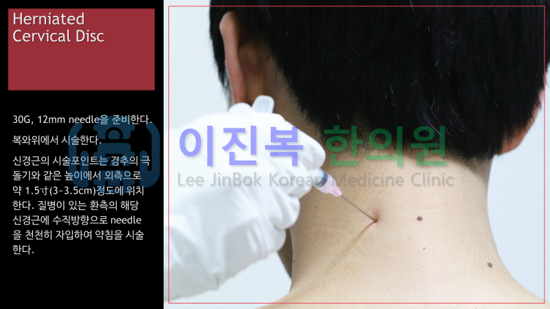 전주 이진복한의원 경추 추간판탈출증경추 디스크
