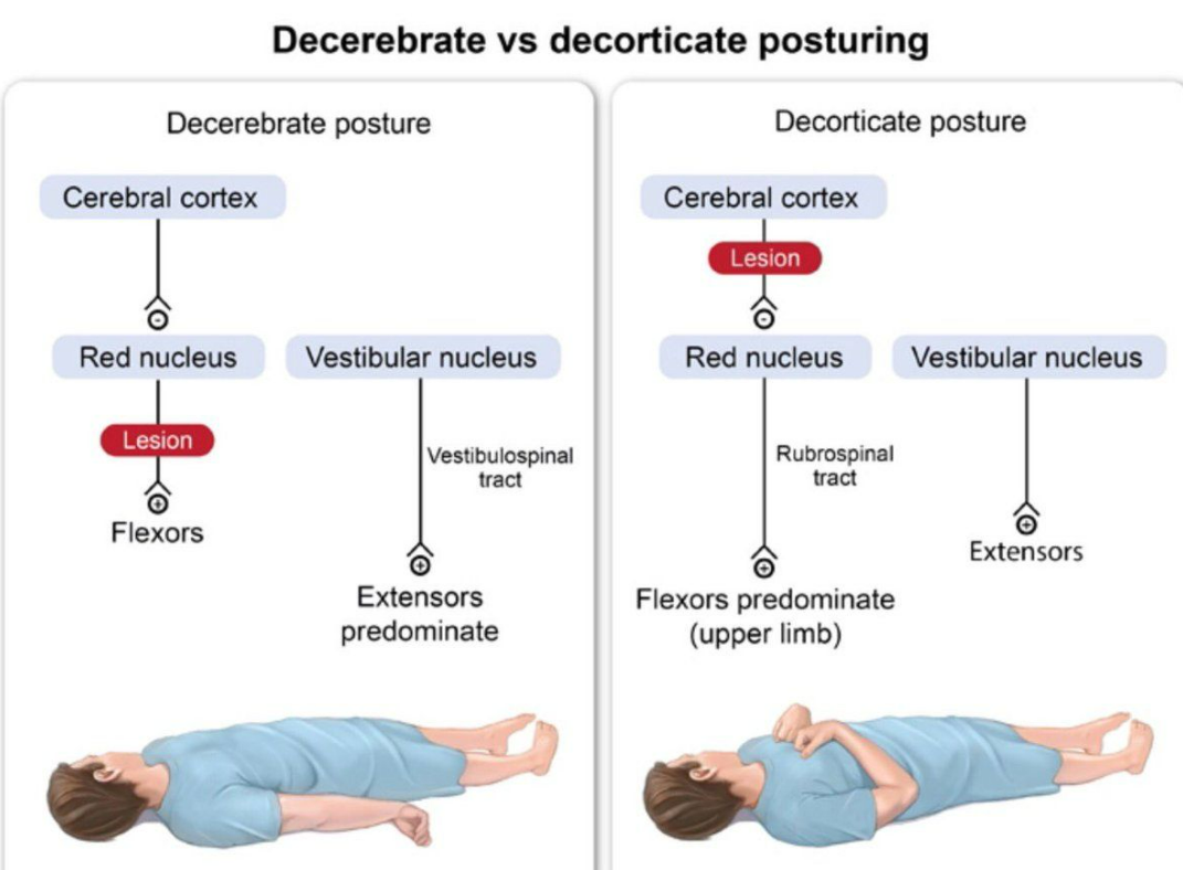 GCS(Glasgow coma scale) 영문 자료 해석하기