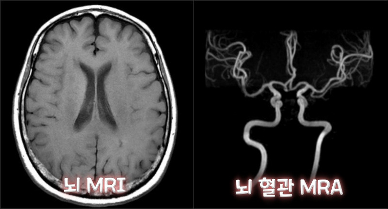 MRI와 MRA 검사 차이점과 검사 비용 등 주의사항