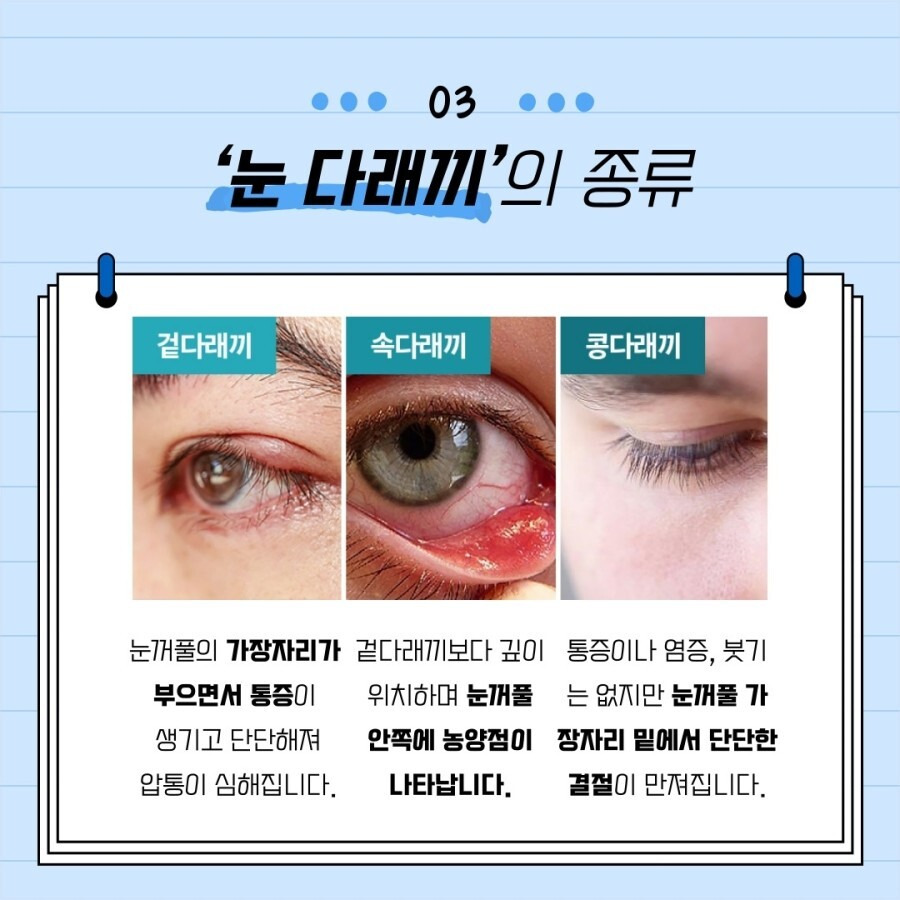 다래끼 예방과 치료 방법에 대해 알아보자