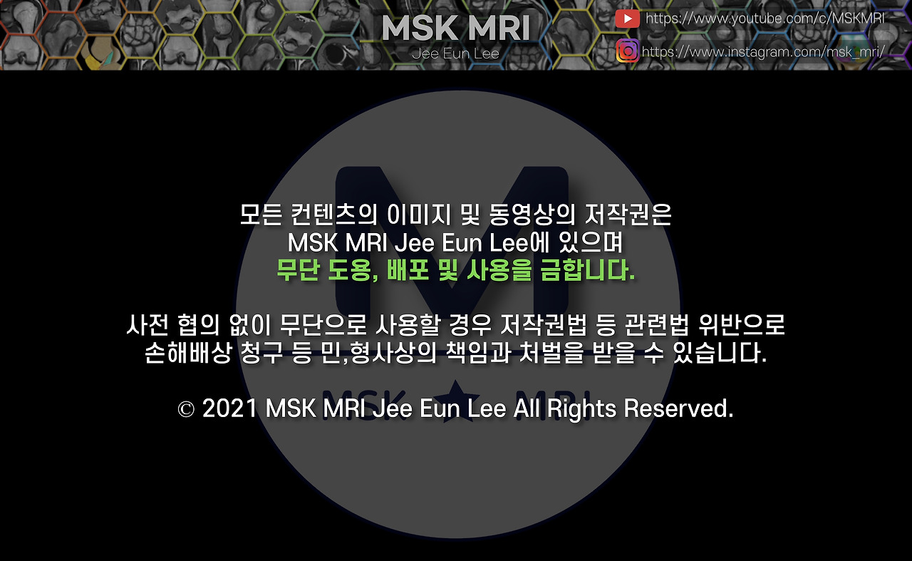 [Tear_25] Ramp lesion_Type 4A: complete peripheral posterior horn ...