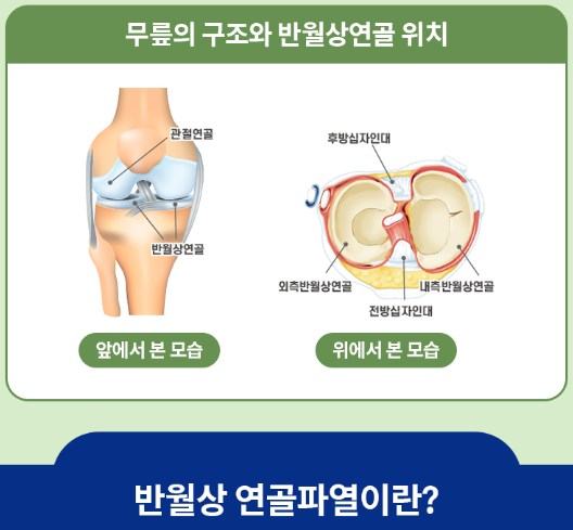 반월상 연골 파열 수술 증상 및 치료