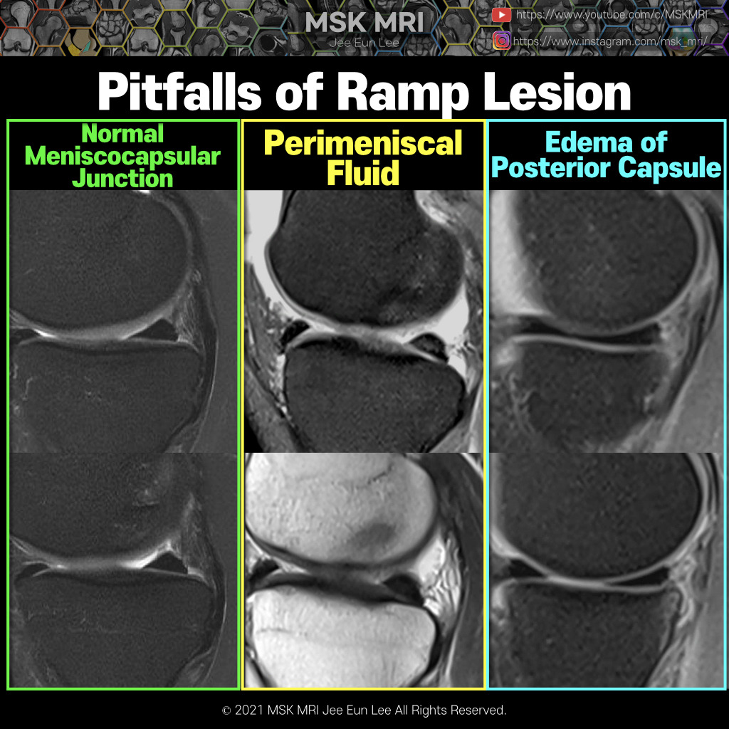 [Tear_28] Ramp lesion_Pitfalls, perimeniscal fluid, edema of posterior ...