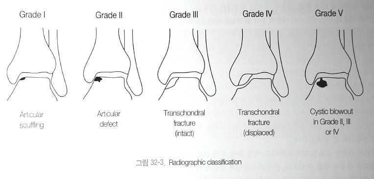 족관절 슬관절의 박리성 골연골염 Ankle And Knee Ocd Osteochondral Dissecans