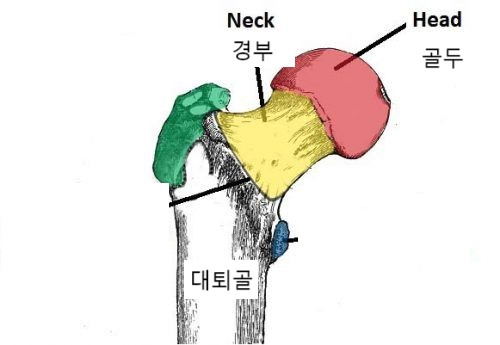 대퇴골 경부 골절 고관절 골절