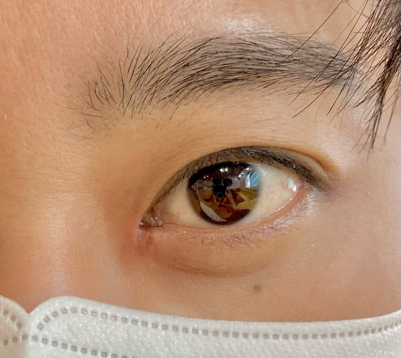 신림피부과 강한신림의원 눈가 비립종 Co2레이저로 제거하기 비용 위치