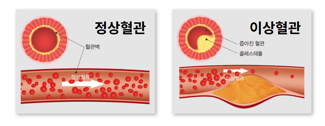 콜레스테롤 높은 이유 낮추는 방법 추천 음식