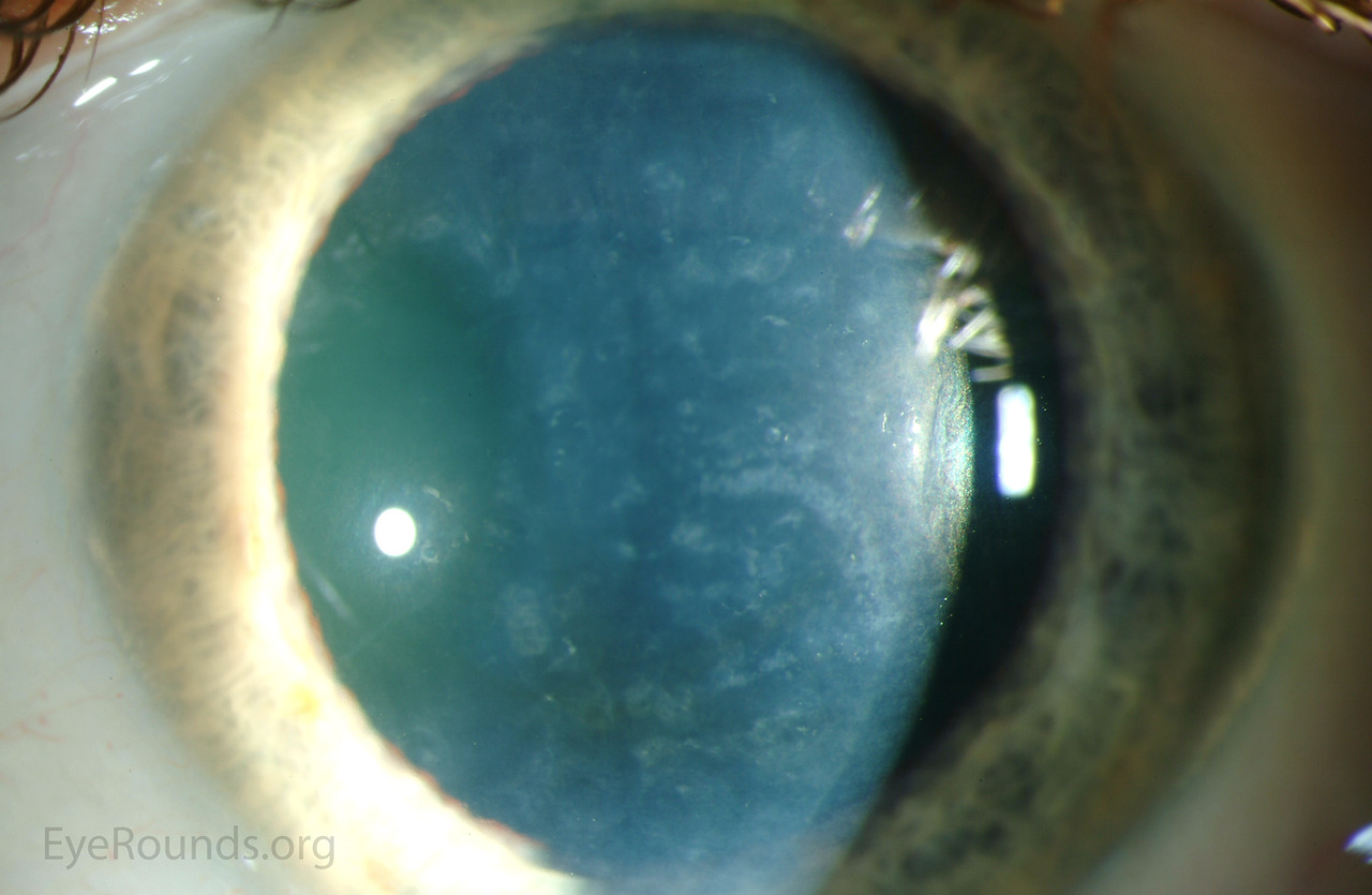 PPMD(Posterior Polymorphous Corneal Dystrophy, PPCD), 후부다형각막이상증의 원인, 치료 ...