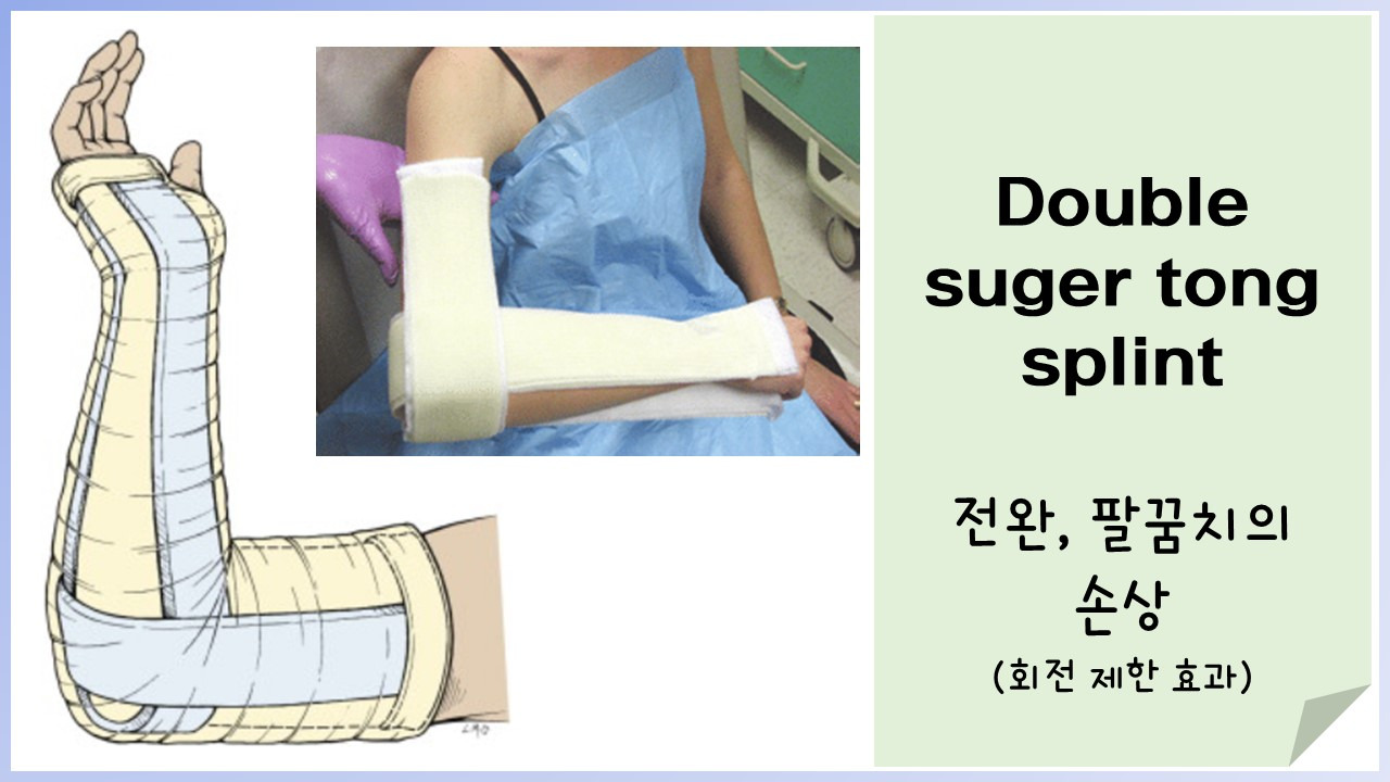 [썬널스] splint - 종류, 적응증