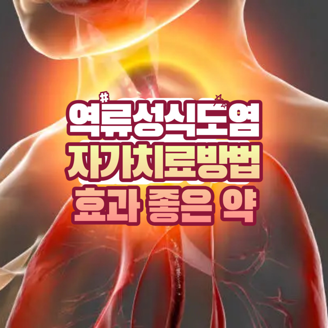 역류성 식도염 자가 치료 방법 및 효과 좋은 약