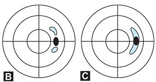 녹내장 시야 : 산란, 비에룸영역, 중심부근암점, 활모양암점, 자이델암점, 고리결손