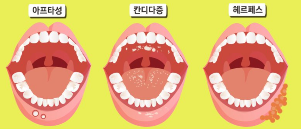 피곤하면 생기는 구내염에 좋은 음식과 예방법