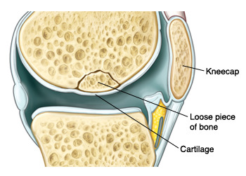 족관절, 슬관절의 박리성 골연골염 (ankle & knee OCD, osteochondral dissecans)