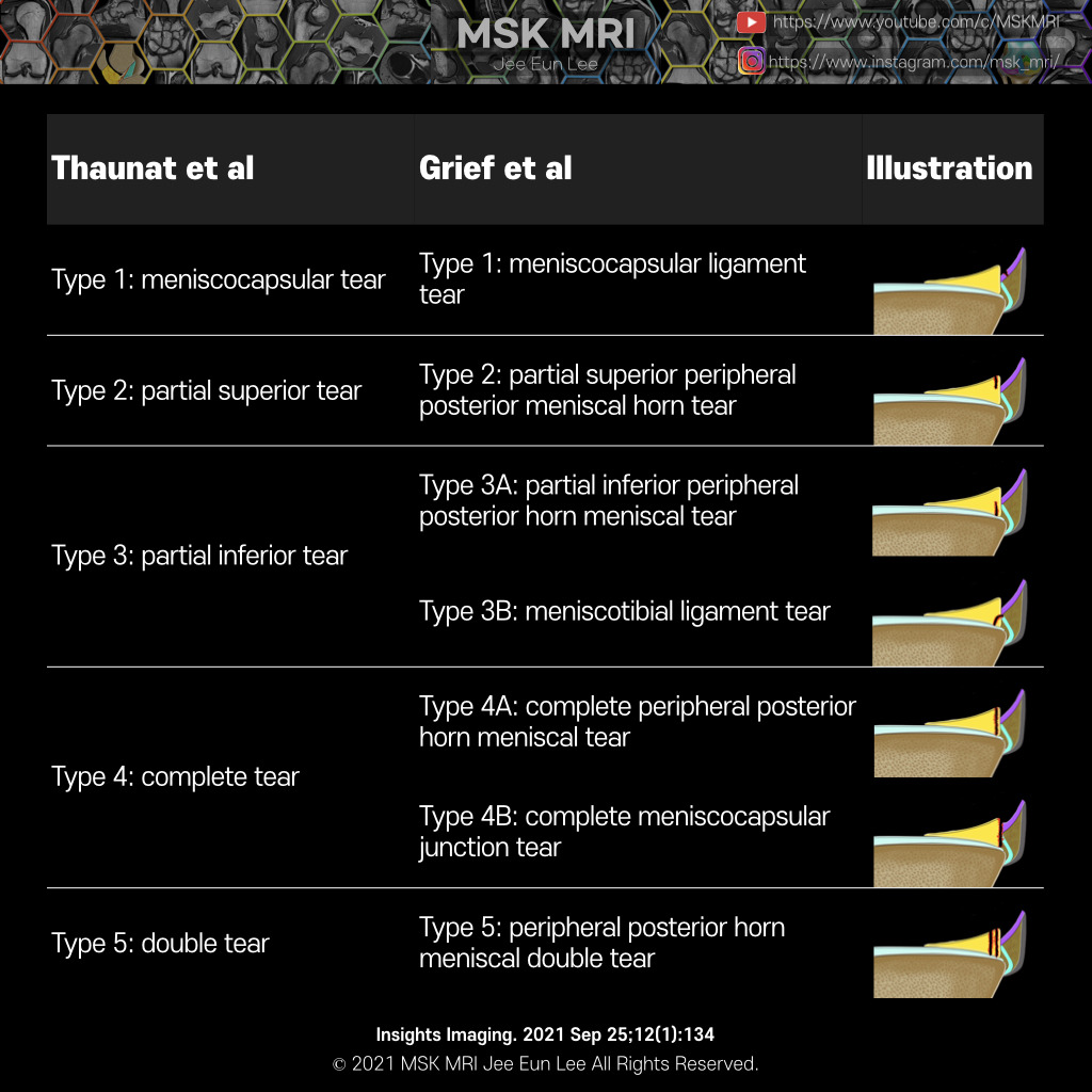 [Tear_19] Ramp lesion_Type 1: meniscocapsular ligament tear