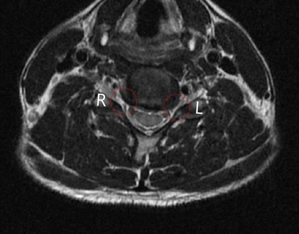 목디스크 진단 경추 MRI - 실비로 만원에 찍는 방법 (건강관리협회)
