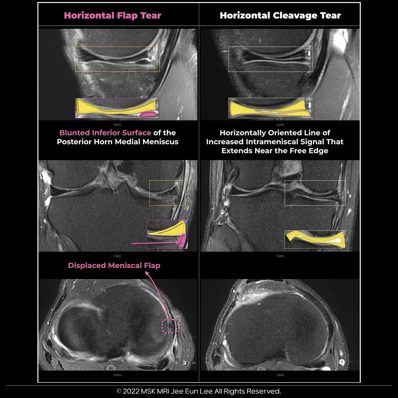 (Fig 1-B.17) Horizontal tear versus horizontal flap tear
