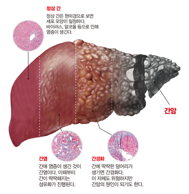 Ebs 간 이식 명의 주동진 교수 간경화 증상 간이식 방법 서울인포스트