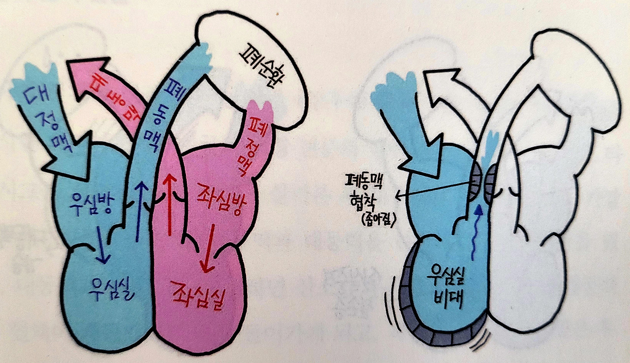 선천성 심장 기형 팔로 네증후