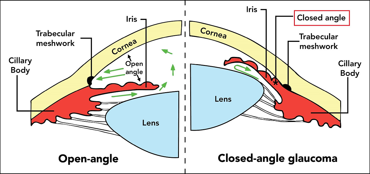 녹내장 수술 후 동공차단 녹내장(Pupillary block glaucoma) : 안압이 높고, 전방이 얕은 경우, High ...