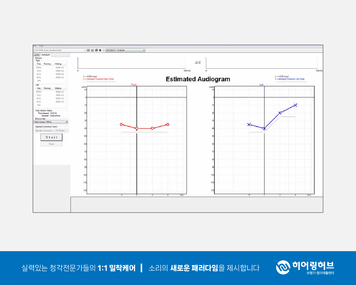 청성뇌간반응검사 Abr 청성지속반응 검사 Assr 차이점 소요시간 알려드립니다