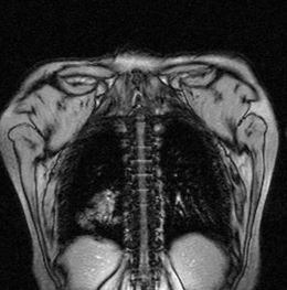 MRI Artifacts(아티팩트) 종류 정리