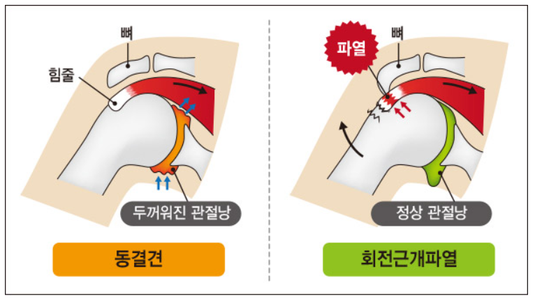 Ebs 명의 임태강 교수 어깨통증 오십견 회전근개 명의 알아보기 서울인포스트