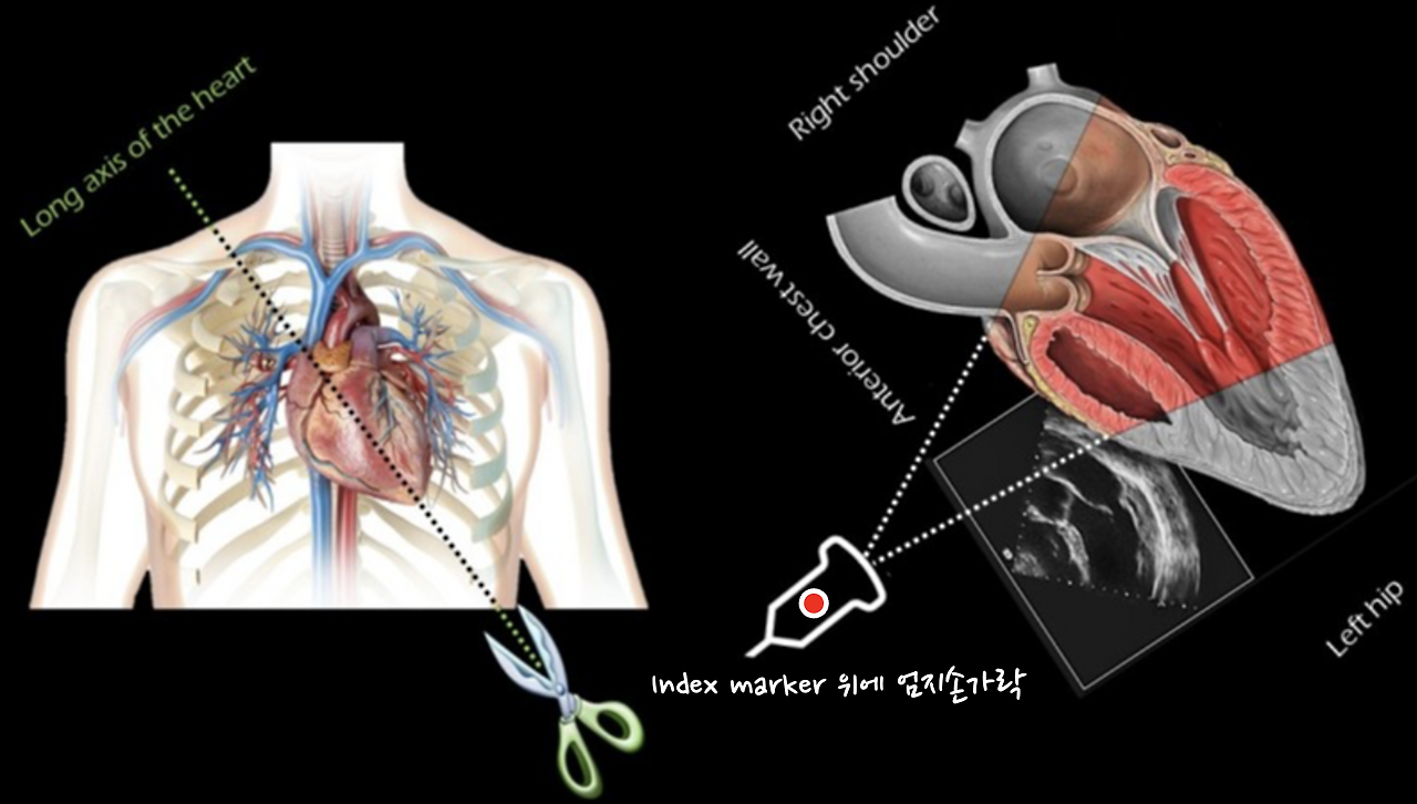 [심초음파] PLAX or PSLA (parasternal long axis view)