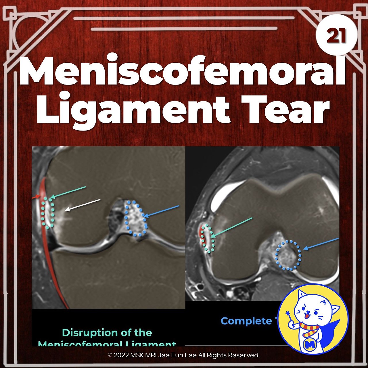 (Fig 3-A.21) Meniscofemoral Ligament Tear
