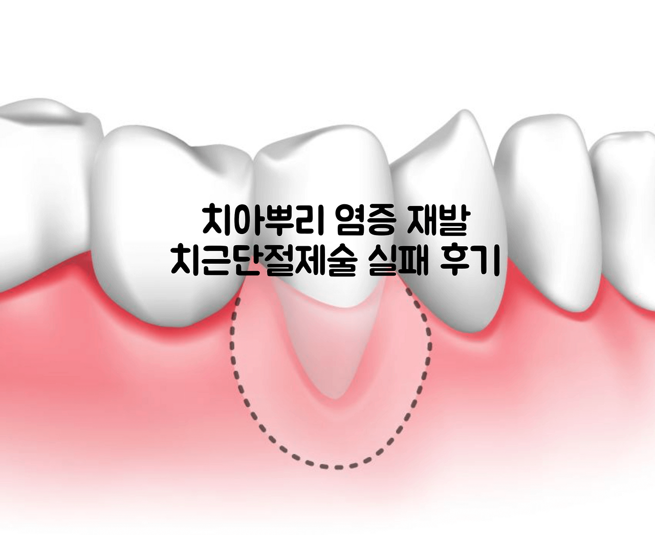 치아뿌리 염증 재발 치근단절제술 실패 후기