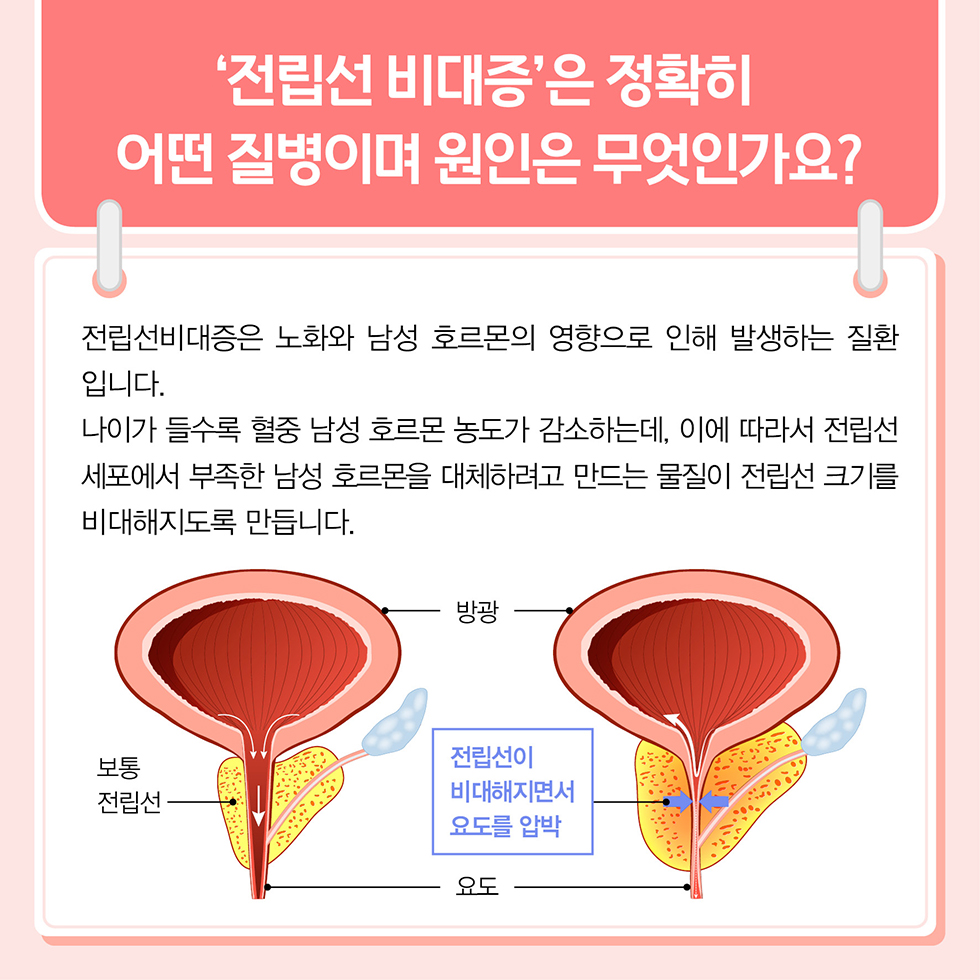 전립선비대증 환자에게 알코올은 방광 수축 및 이완을 방해하고 감기약에 들어 있는 항히스타민제 또한 방광 수축 능력을 저하시킨다