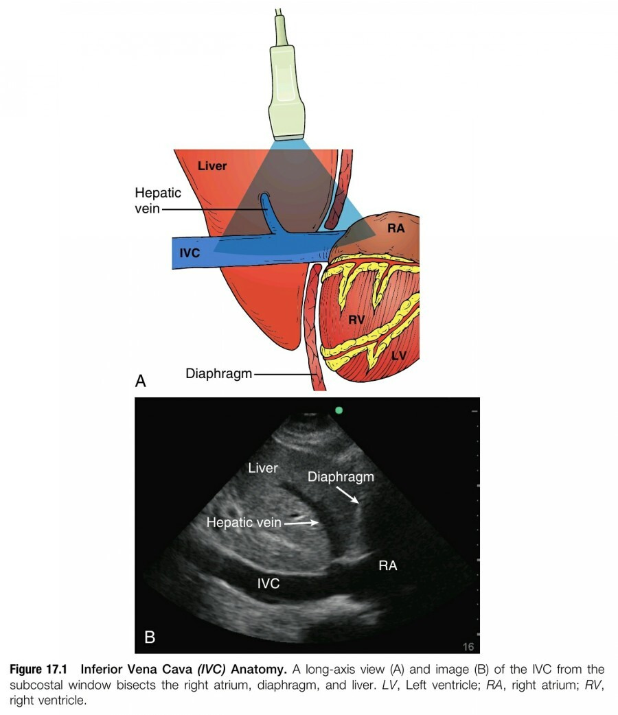 초음파를 이용한 interior vena cava(하대정맥)의 평가_1