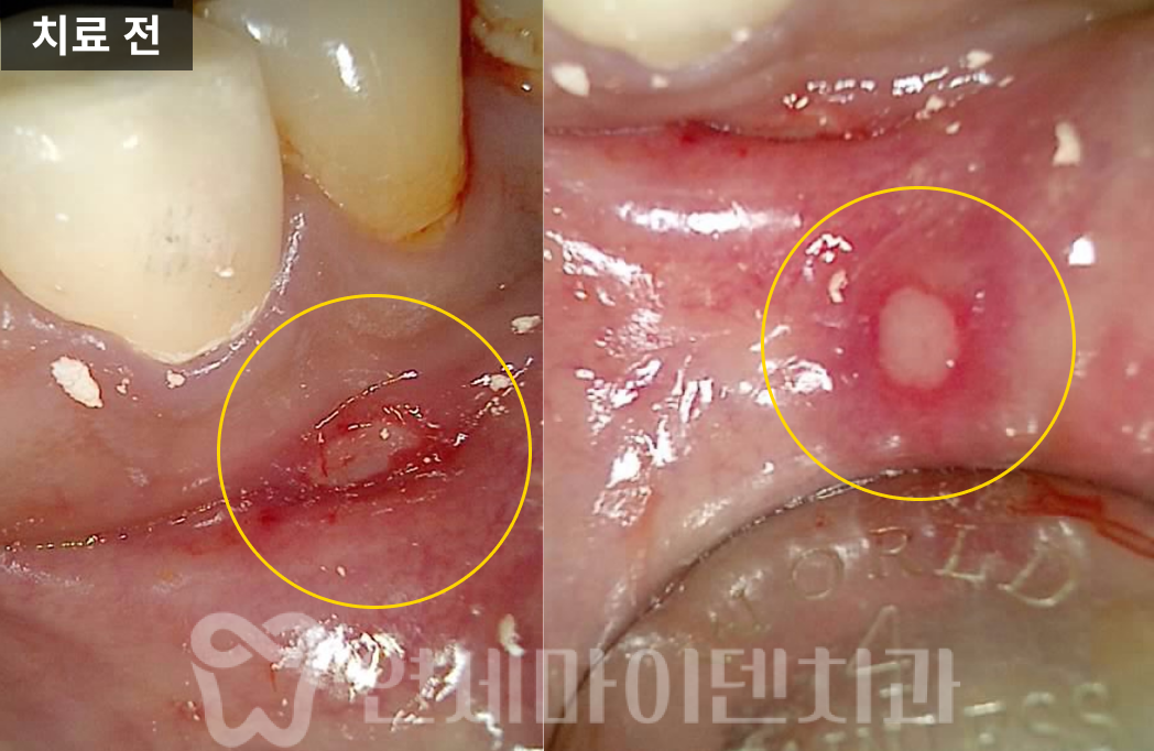 잇몸 염증으로 인한 치경부 마모증 보존치료 증례 종각치과 연세마이덴치과🦷