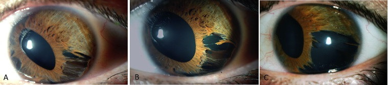 ICE syndrome, 챈들러 증후군(Chandler syndrome)과 진행성 홍채위축(Progressive ...