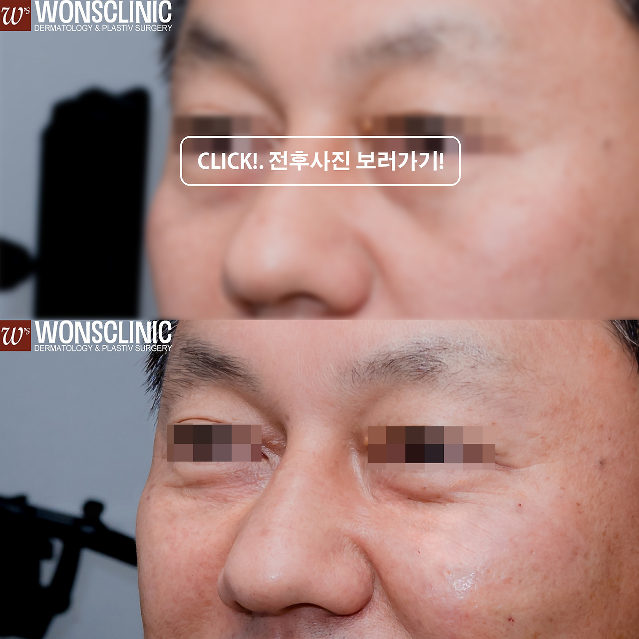 수원피부과 원스의원 눈밑필러 앞광대필러 전후사진 20221224